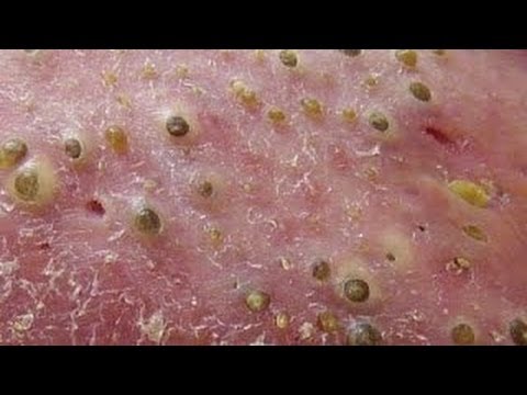 Giant black head - Huge compilation of Pimple Popping, blackheads ...