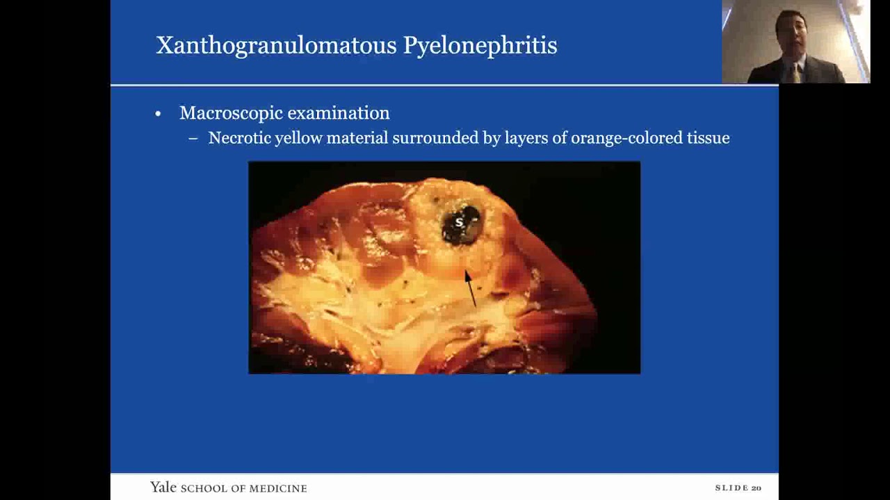 Xanthogranulomatous Pyelonephritis