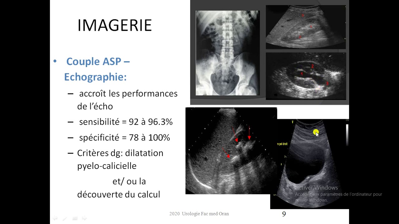 LA COLIQUE NEPHRETIQUE Pr BENATTA M - YouTube