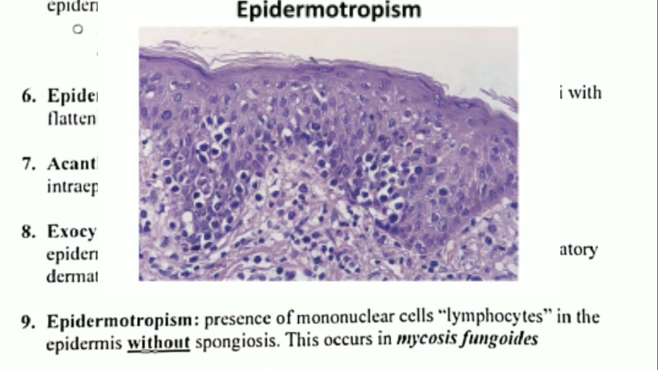 Histopathology 4 👉 Spongiosis & Epidermotropism - YouTube