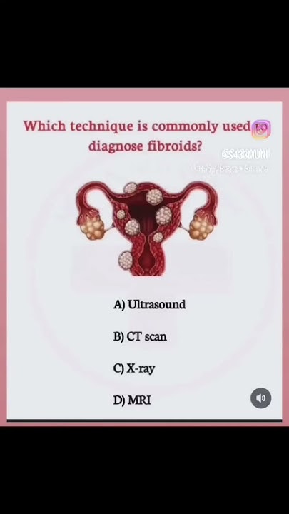 Diagnostic of fibroids....? - YouTube