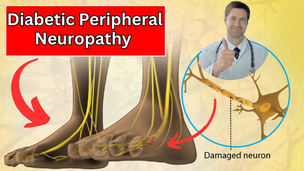 Understanding Diabetic Peripheral Neuropathy Causes, Symptoms, and ...