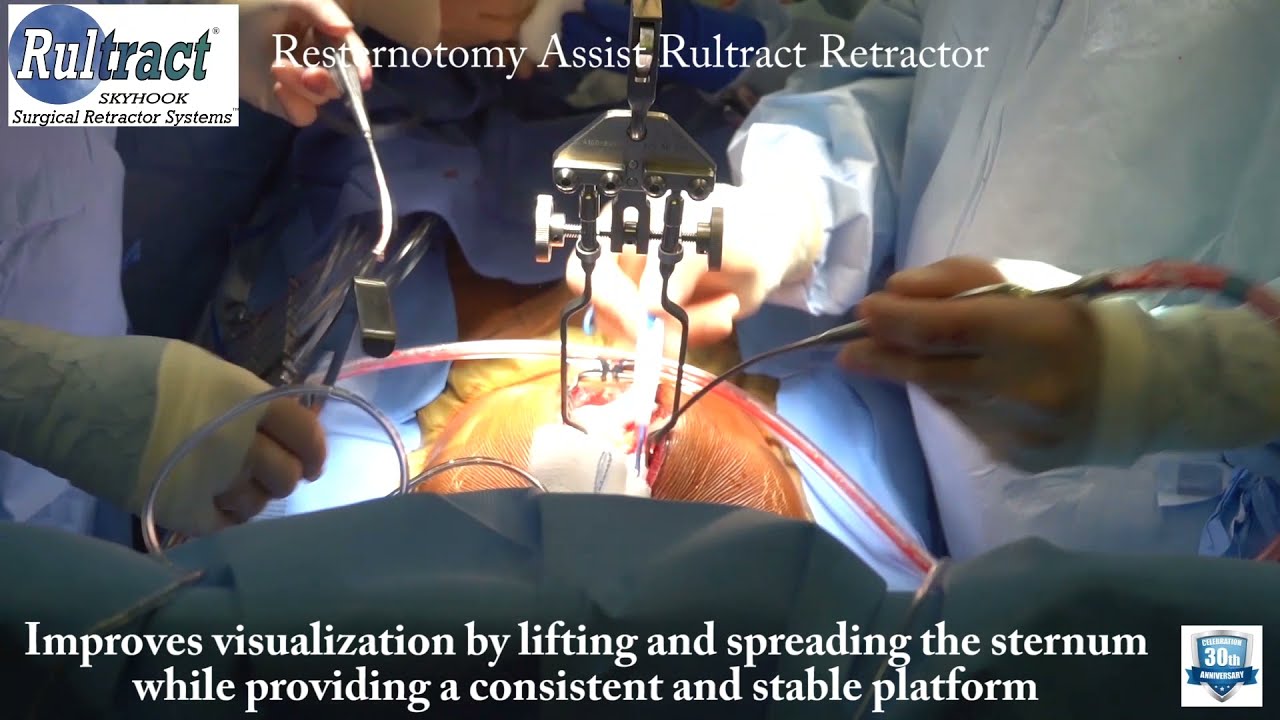 Rultract Resternotomy Retractor for safe sternal reentry - YouTube