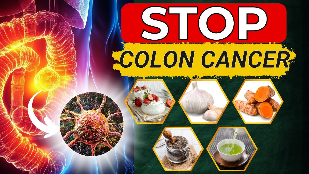 MIRACLE CURE? 7 Foods to Eliminate Colon Polyps & Stop Bowel Cancer ...