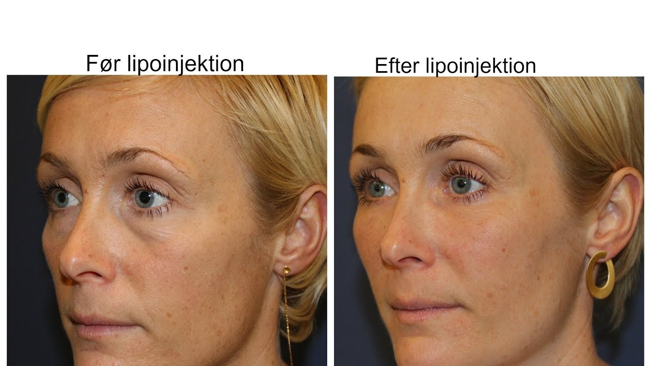 lipoinjection i ansigtet - YouTube