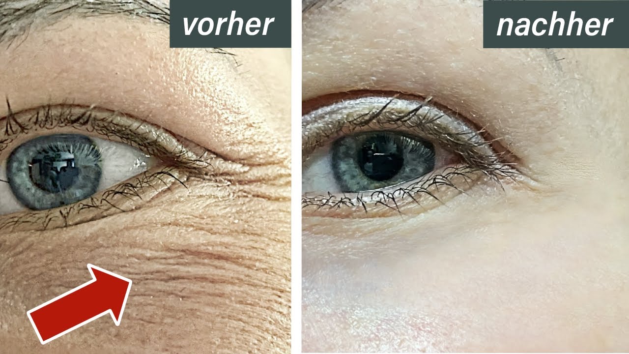 👀 Krasses Ergebnis In 1 Woche Augenfalten loswerden - YouTube