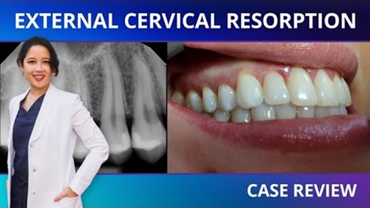 Case Bites | Analyzing External Cervical Resorption with CBCT - YouTube