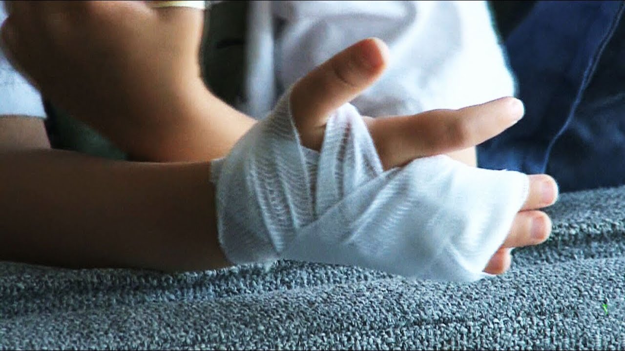 Wild parsnip burns and blisters a 4-year-old boy's hand - YouTube