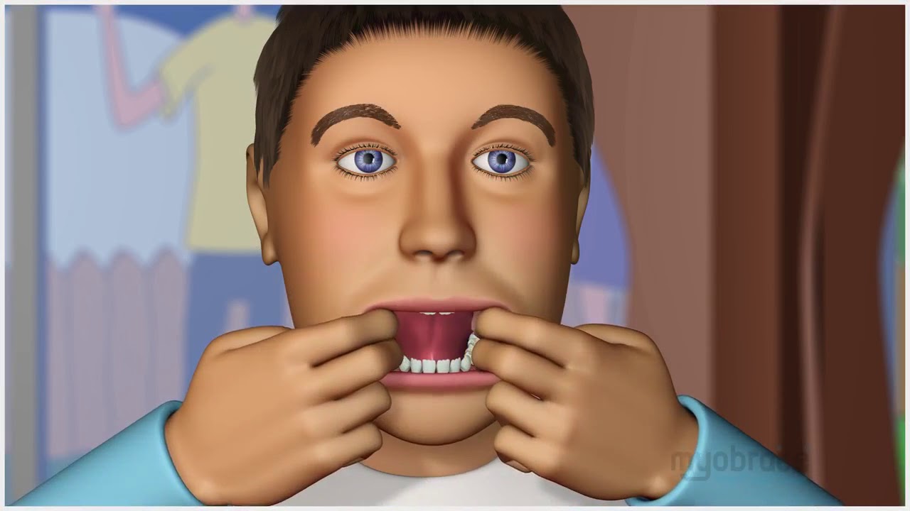 Myobrace Introduction for Parents and Patients - YouTube