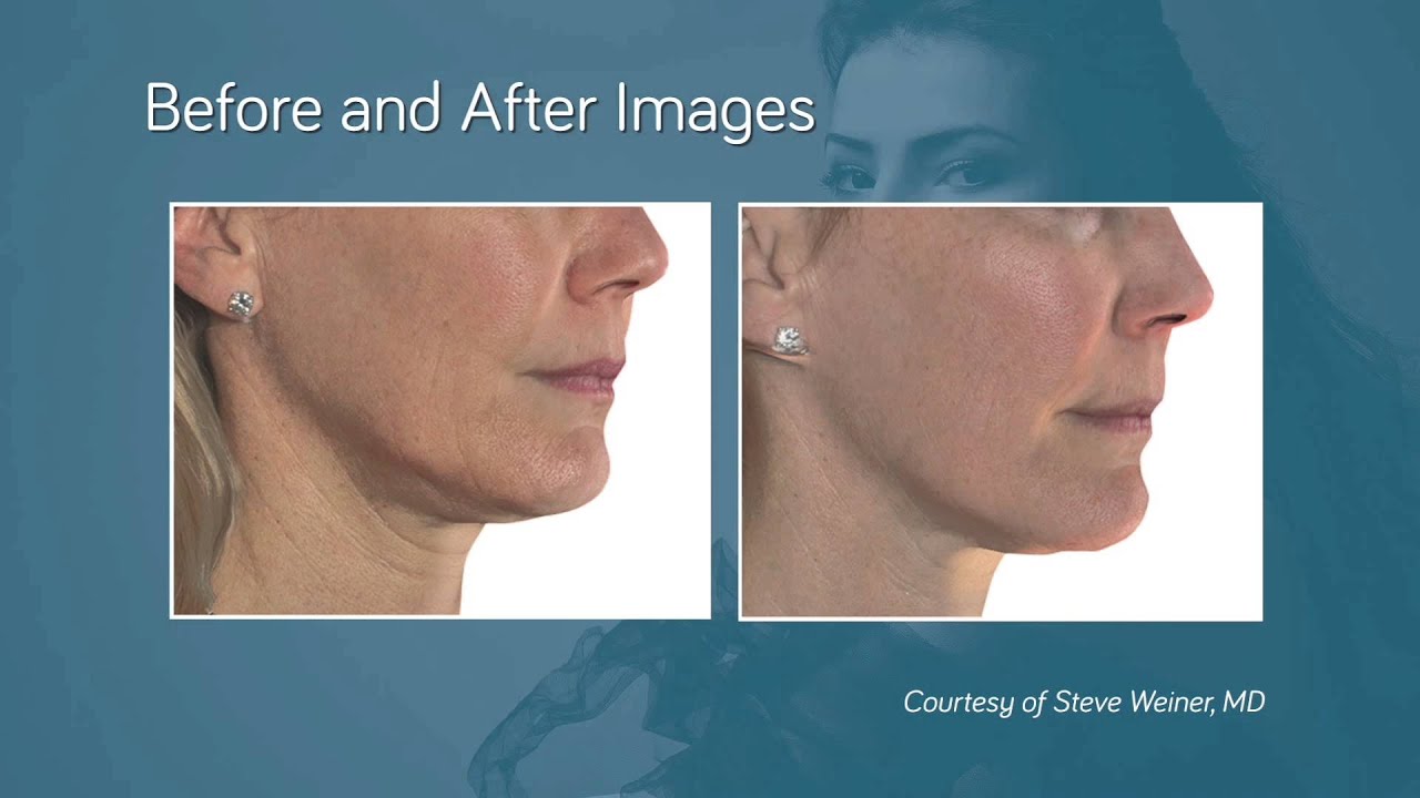 Infini Skin Treatment - YouTube