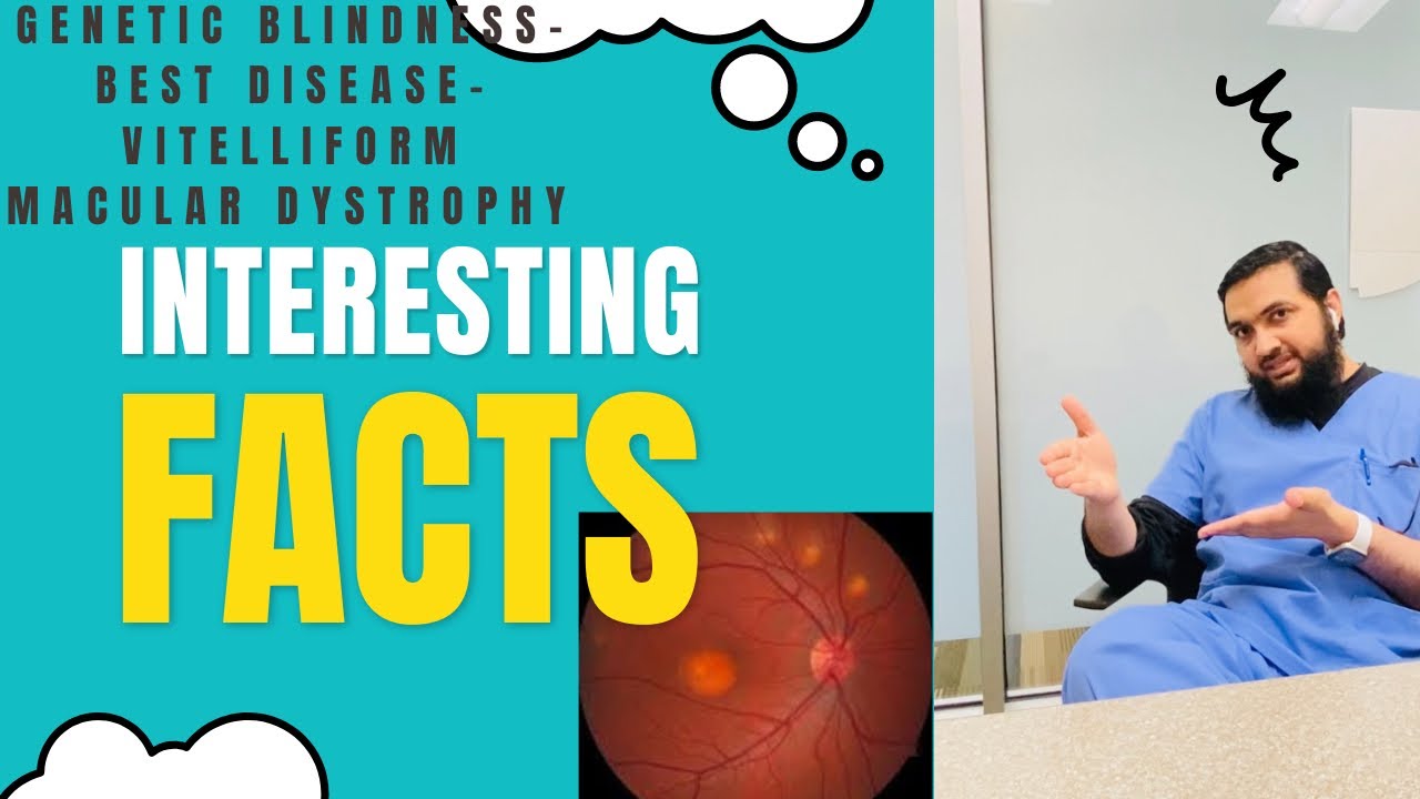 Vitelliform Macular Dystrophy(Best Disease)-genetic blindness and it’s ...