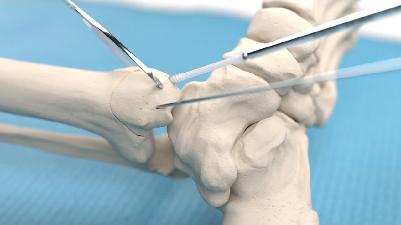Medial malleolar osteotomy and talar osteochondral fragment fixation ...