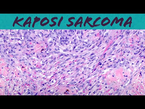 Kaposi sarcoma (vascular tumor pathology histology dermpath dermatology dermatopathology HIV AIDS)