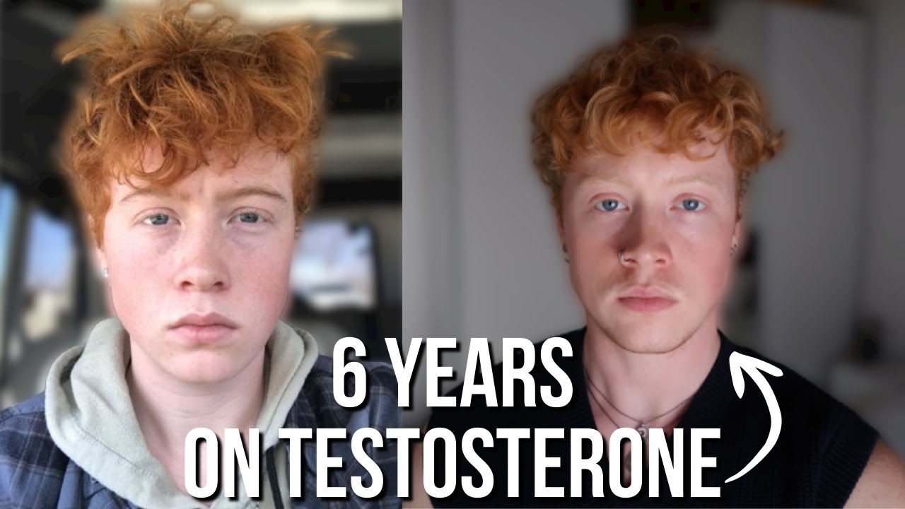 6 YEARS ON TESTOSTERONE | FTM TRANSGENDER - YouTube
