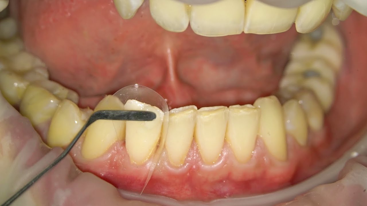 Installing a new filling in the problematic front tooth. Dentist POV - YouTube