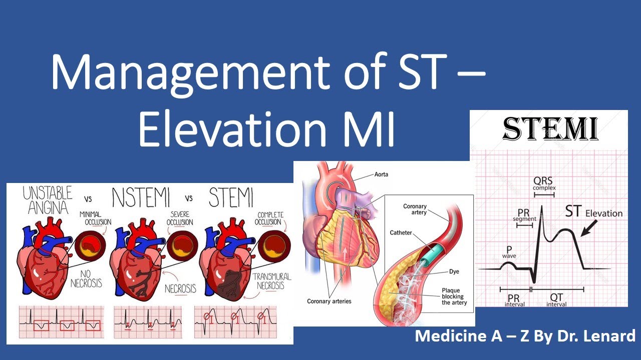 Management of ST – Elevation MI , Time to thrombolysis, Choosing and ...