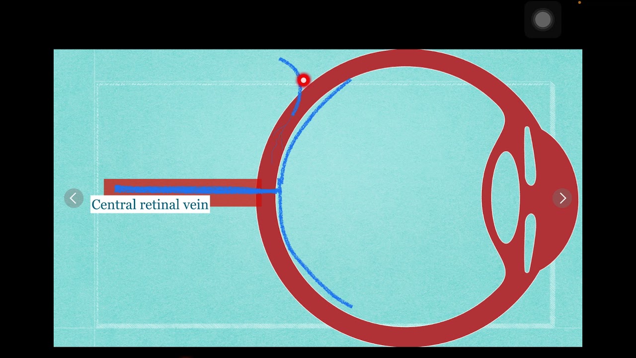 Optociliary shunts, opticociliary collaterals - YouTube