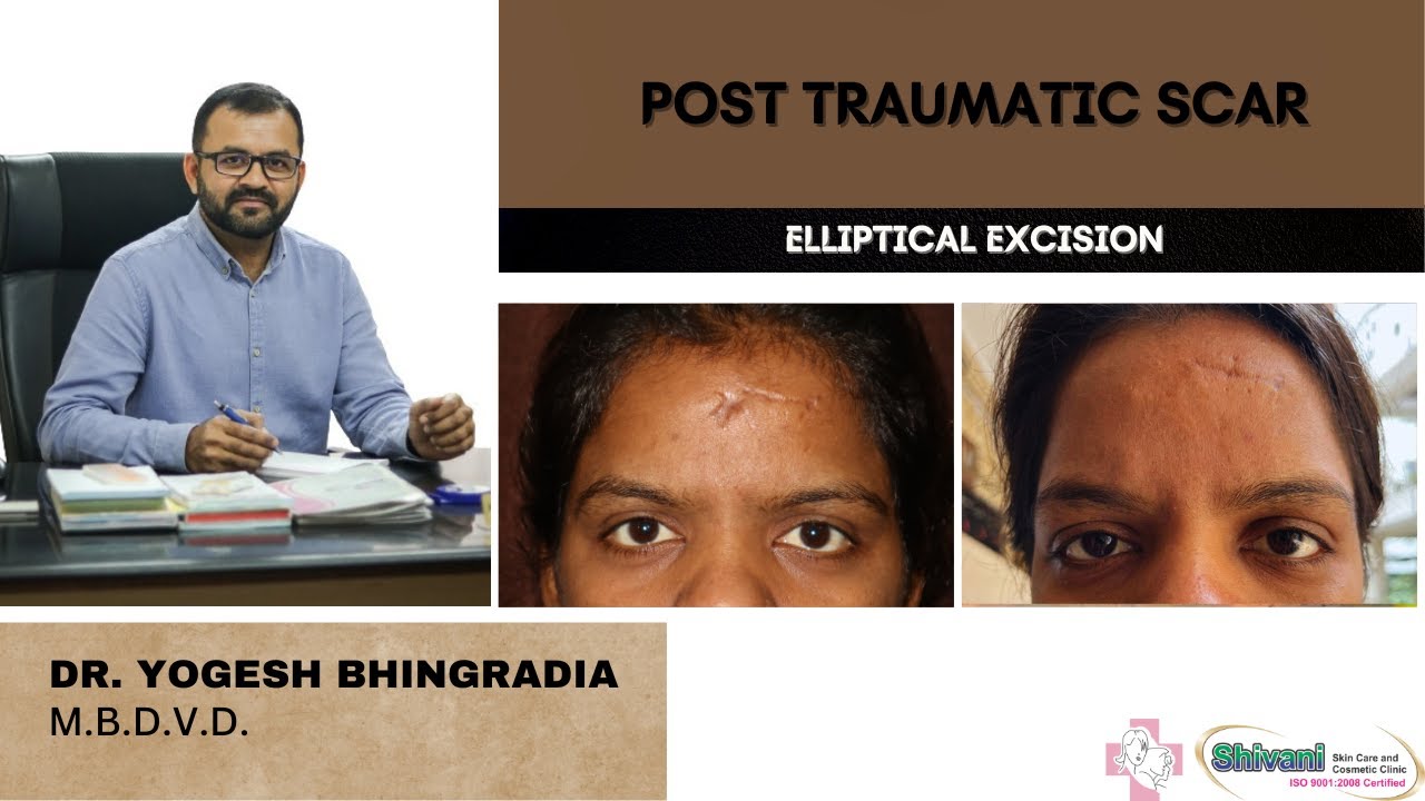 POST TRAUMATIC SCAR | SCAR REVISION | MODIFIED H PLASTY | DR YOGESH ...