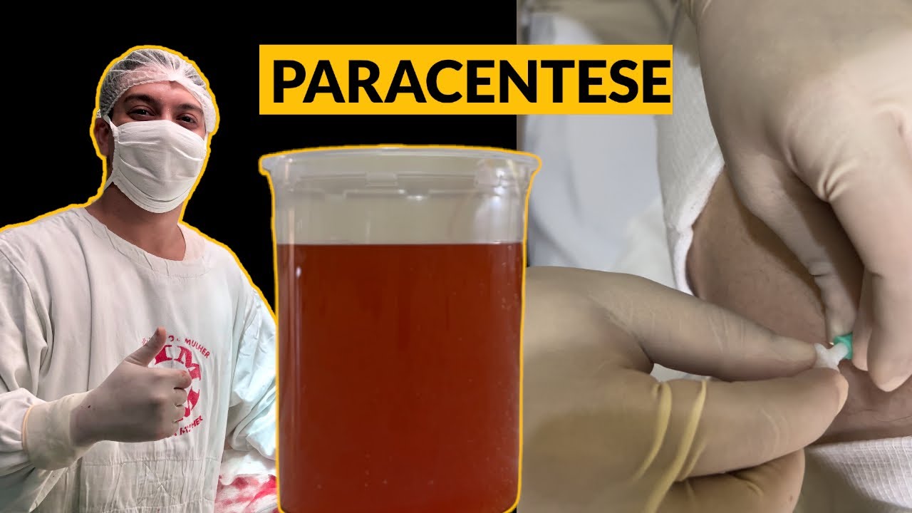 Paracentese • Paracentesis - DR. LUCAS DUARTE [NOV2021] - YouTube