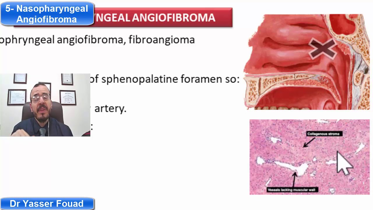 Nasopharyngeal Angiofibroma