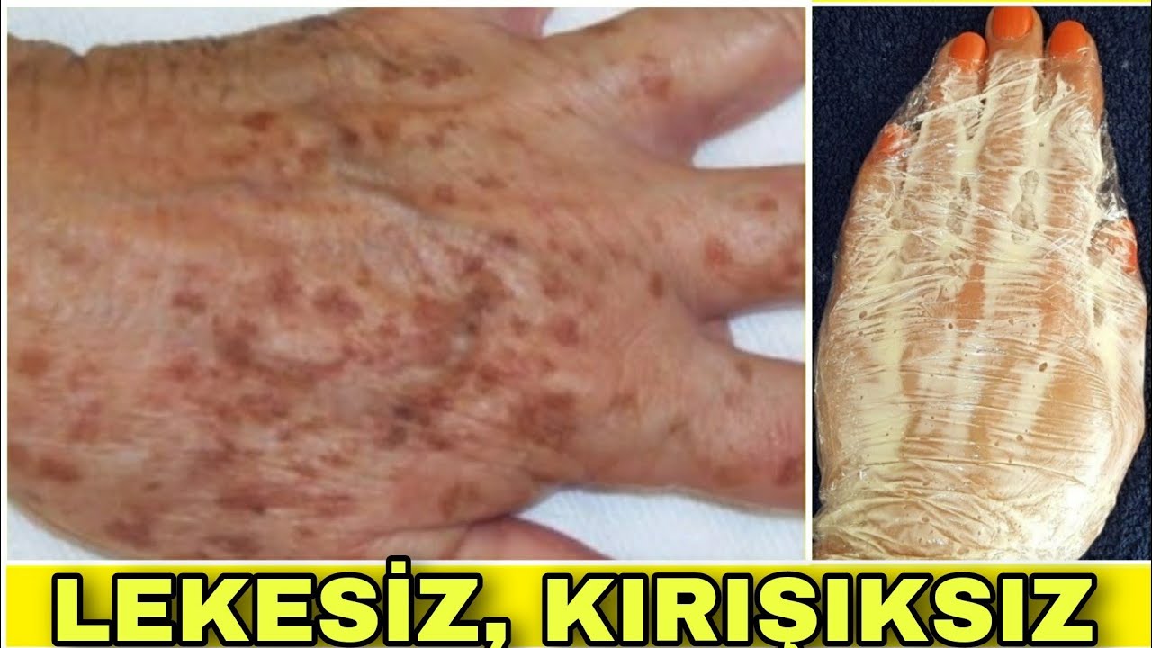 Bu Tarif Ellerdeki LEKELERİ ve KIRIŞIKLARI Gideriyor! 5 YAŞ ...