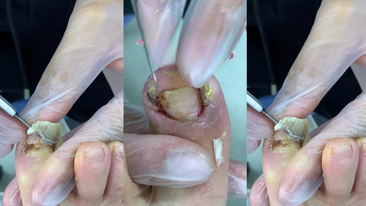 Deep Foot Corn Removal With Callus—Amazing Results! - YouTube