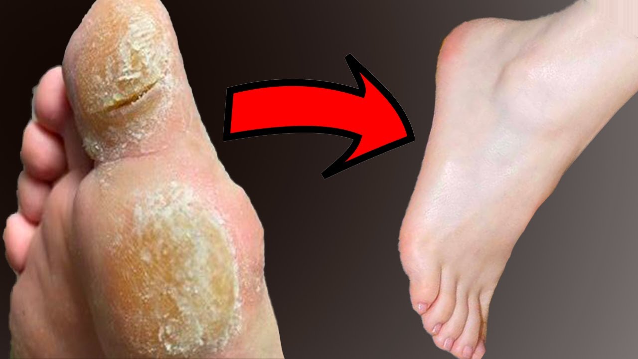 Corne aux Pieds, croutes aux pieds, callosités aux pieds.trempez bos ...