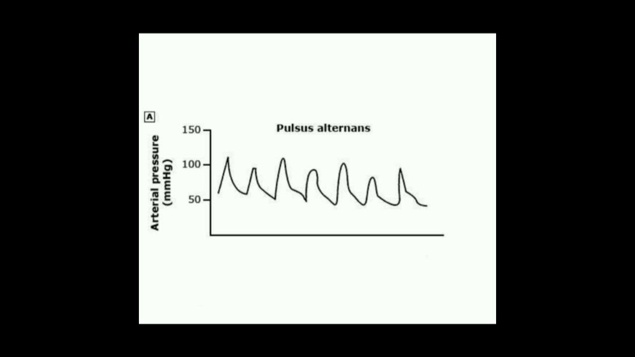 🍁 PULSUS ALTERNANS 🍁 - YouTube