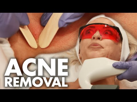 Treating Acne & Blackheads w/ NURSE JAMIE (Beauty Trippin)