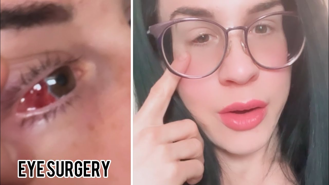 Strabismus Eye Surgery Complete 👁️ - YouTube