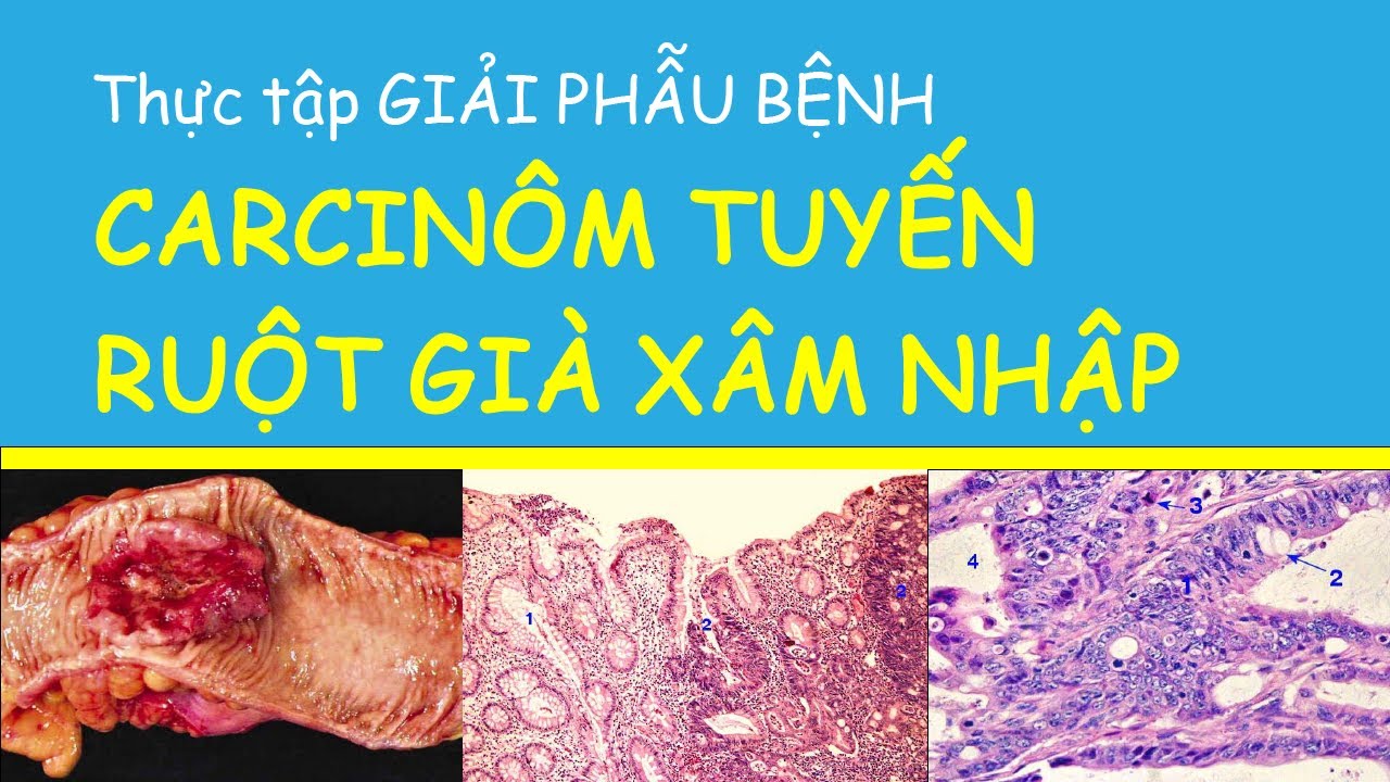 CARCINÔM TUYẾN RUỘT GIÀ XÂM NHẬP | Thực tập Giải phẫu bệnh - Y đa khoa ...
