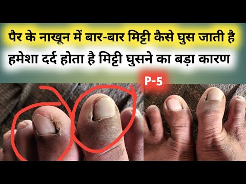 pair ke nakhoon me dard|nakhun ne dukhava|पैर के नाखून में दर्द के कारण ...