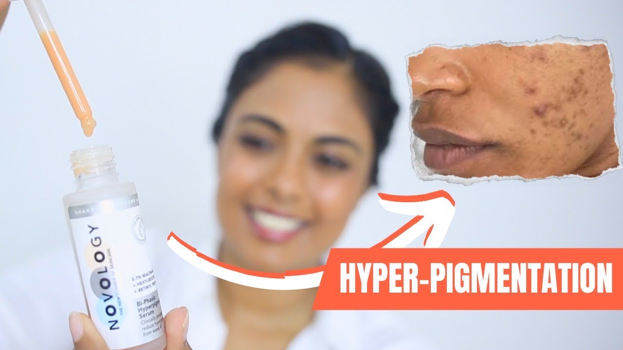 Only 2 Steps!! Finally remove your hyperpigmentation!! - YouTube