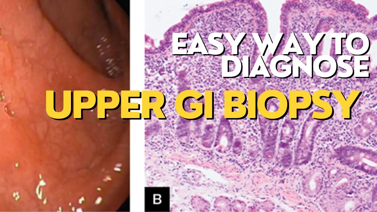 "Mastering Endoscopic Biopsy in Upper GIT: A Case-Based Approach" - YouTube