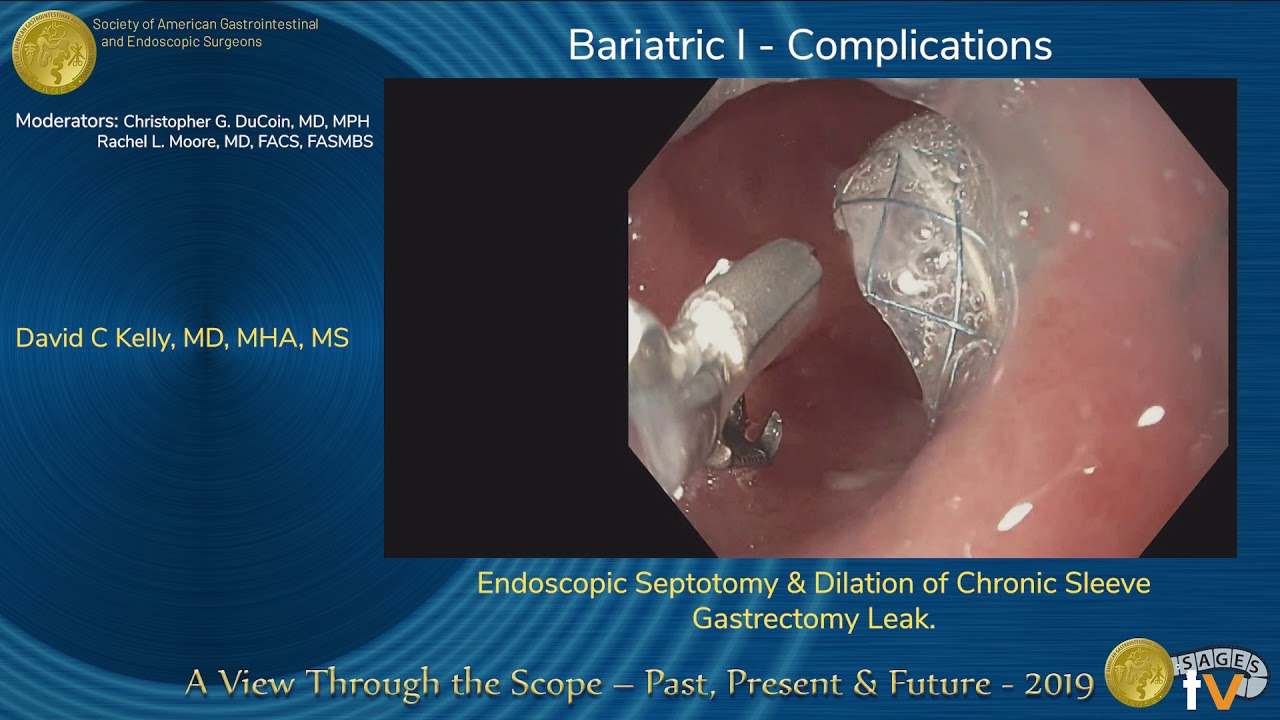 "Endoscopic Septotomy & Dilation of Chronic Sleeve Gastrectomy Leak ...