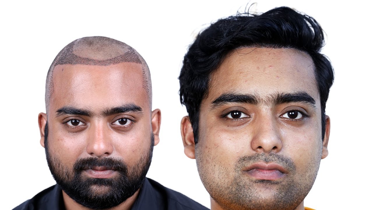 Hair Transplant Hairline & Crown | Dense Hairline | - YouTube
