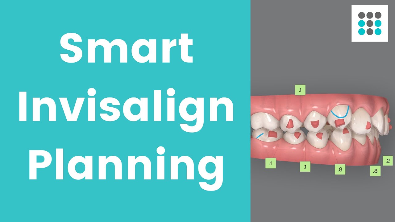 SMART INVISALIGN PLANNING REDUCES TREATMENT TIME: Patient Case Study l ...