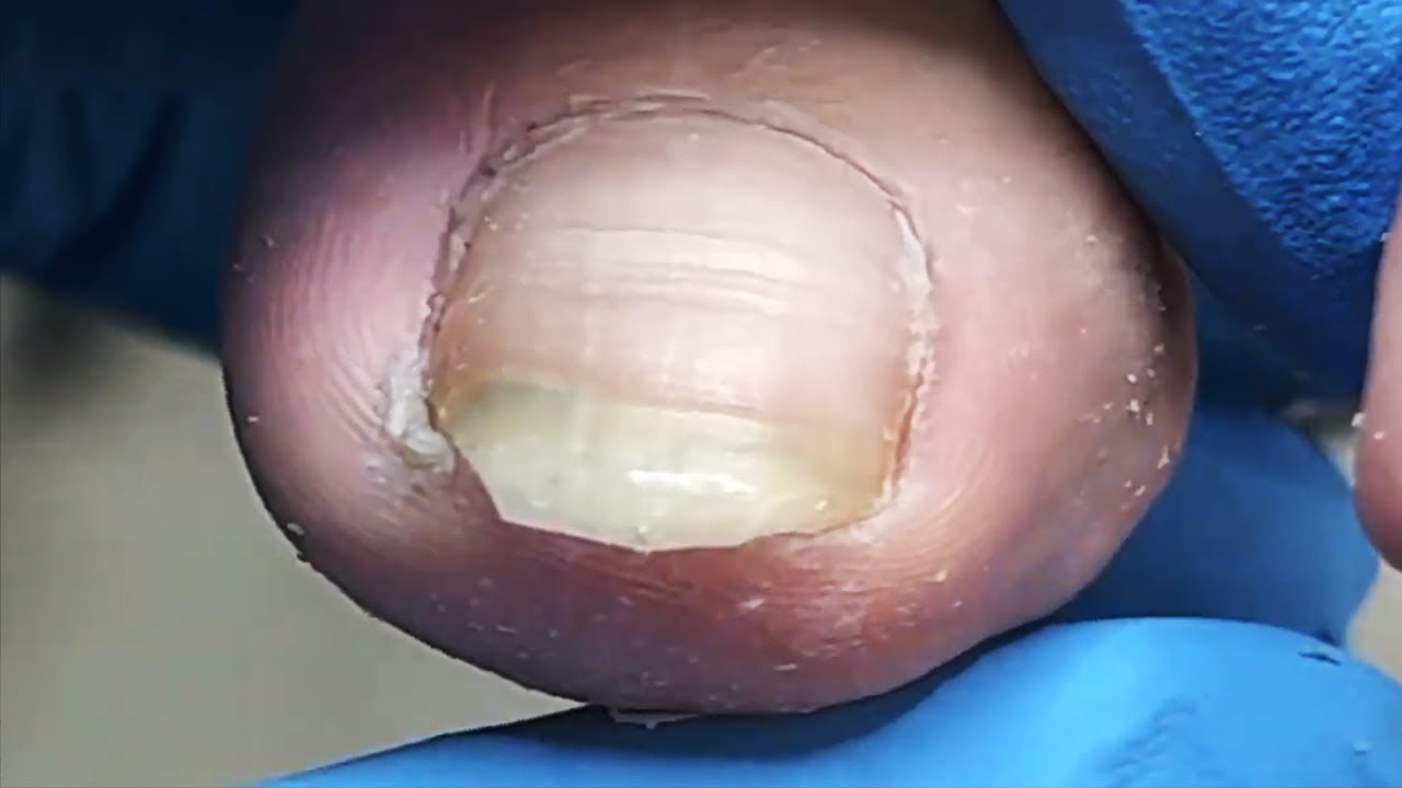 This patient's toenails haven't been trimmed for a long time 【Xue Yidao ...