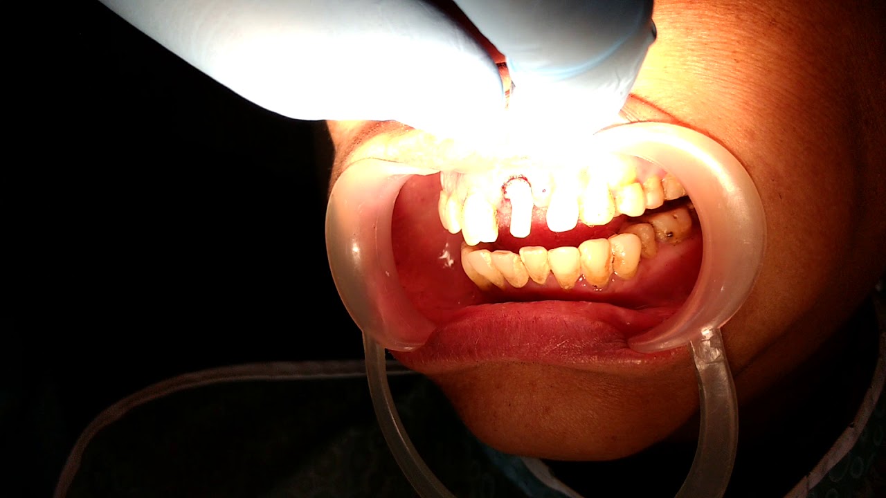 Fibersite Post & Core system - Part -2 - YouTube