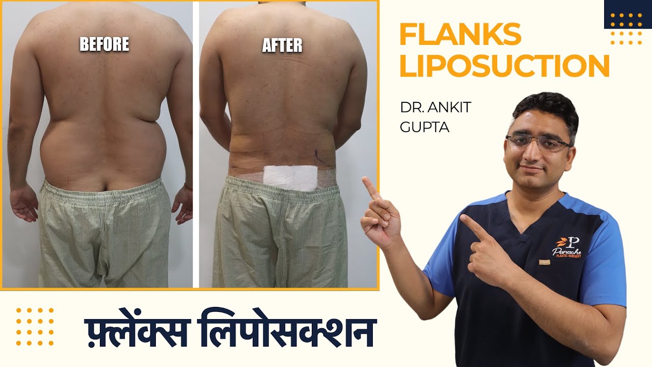 Flanks Liposuction in Delhi - Ideal Candidate, Planning and Steps of ...