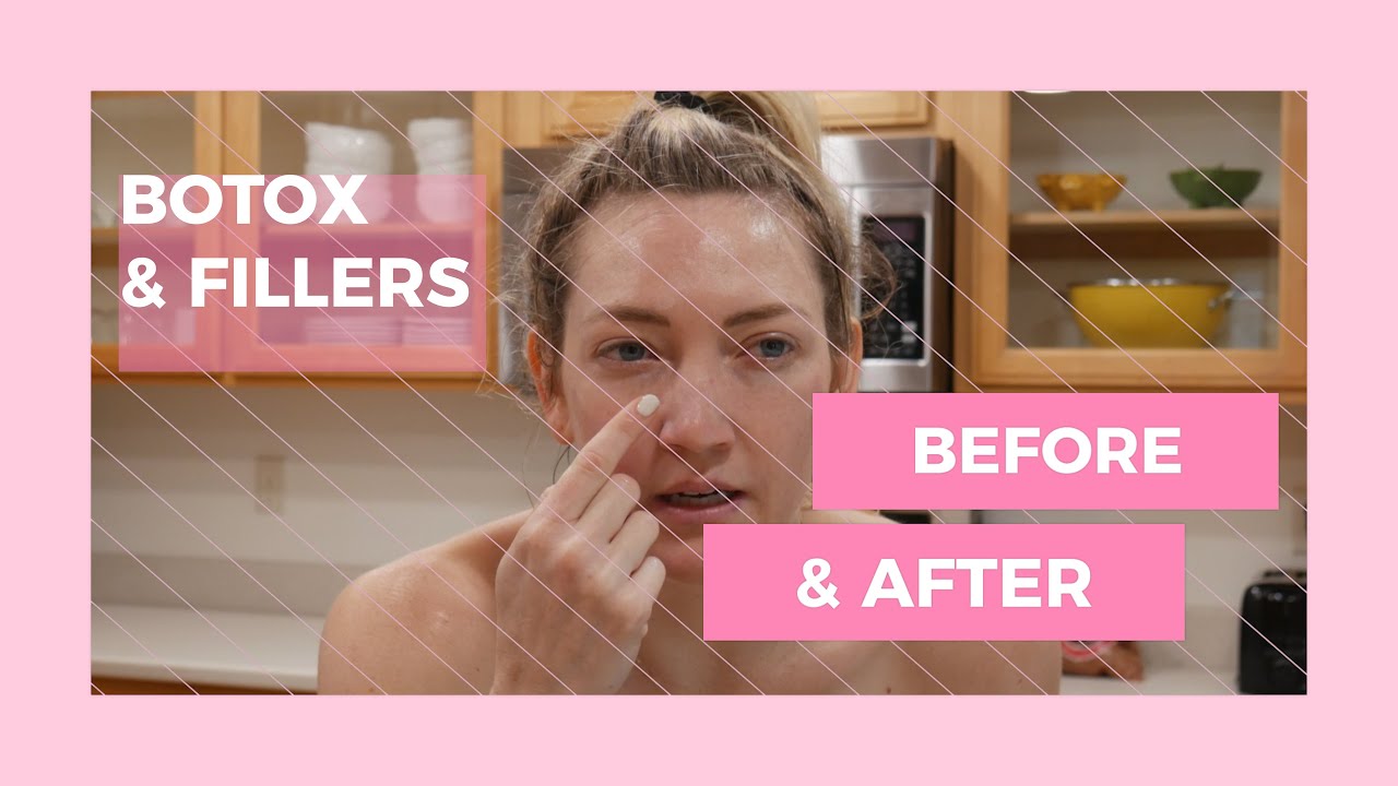 Botox for Crows Feet & Fillers For Under Dark Under Eye Circle & Sunken ...