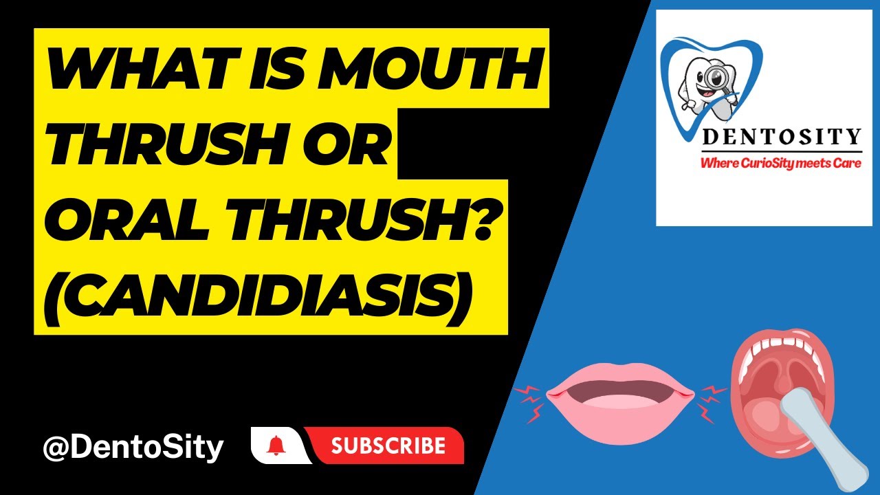What is Mouth Thrush or Oral Thrush? (Candidiasis) #oralhealth ...