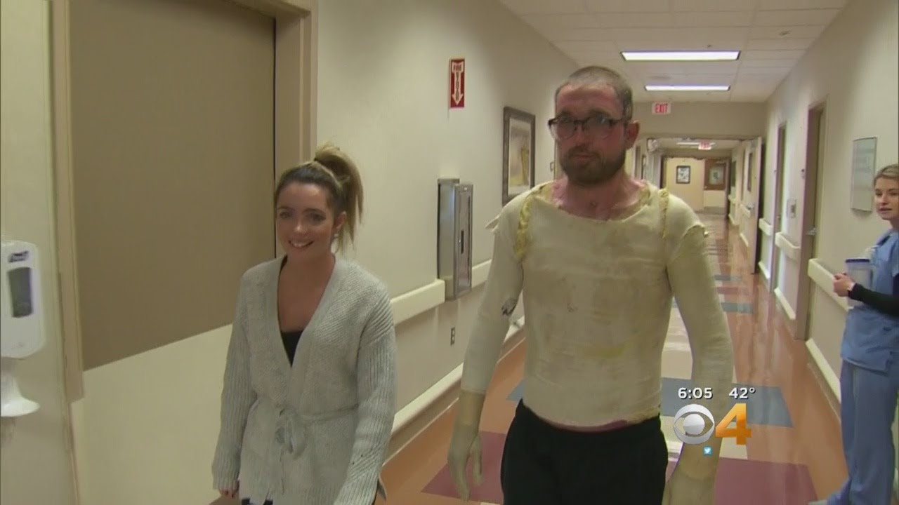 Burn Victim One Of First In World To Get RECELL Treatment - YouTube