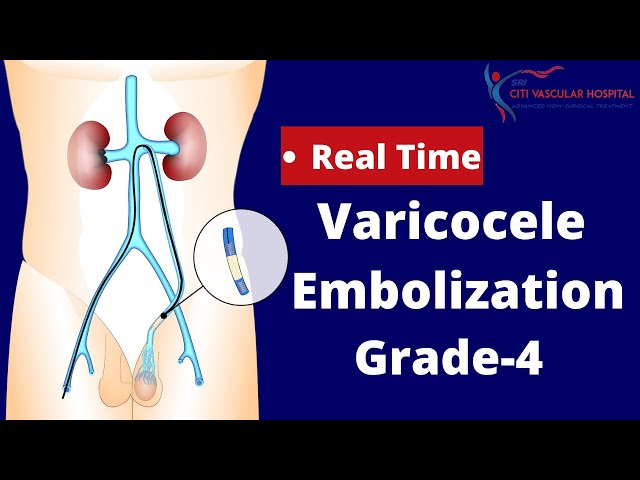 Varicocele Grade 4