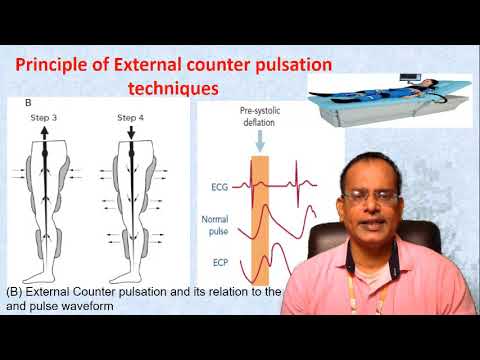 External counter pulsation Technique ECP - YouTube