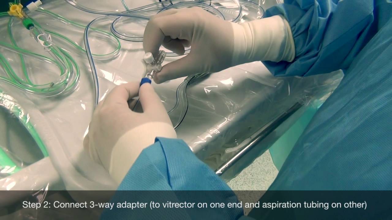Single port automated vitreous biopsy in suspected endophthalmitis: a ...