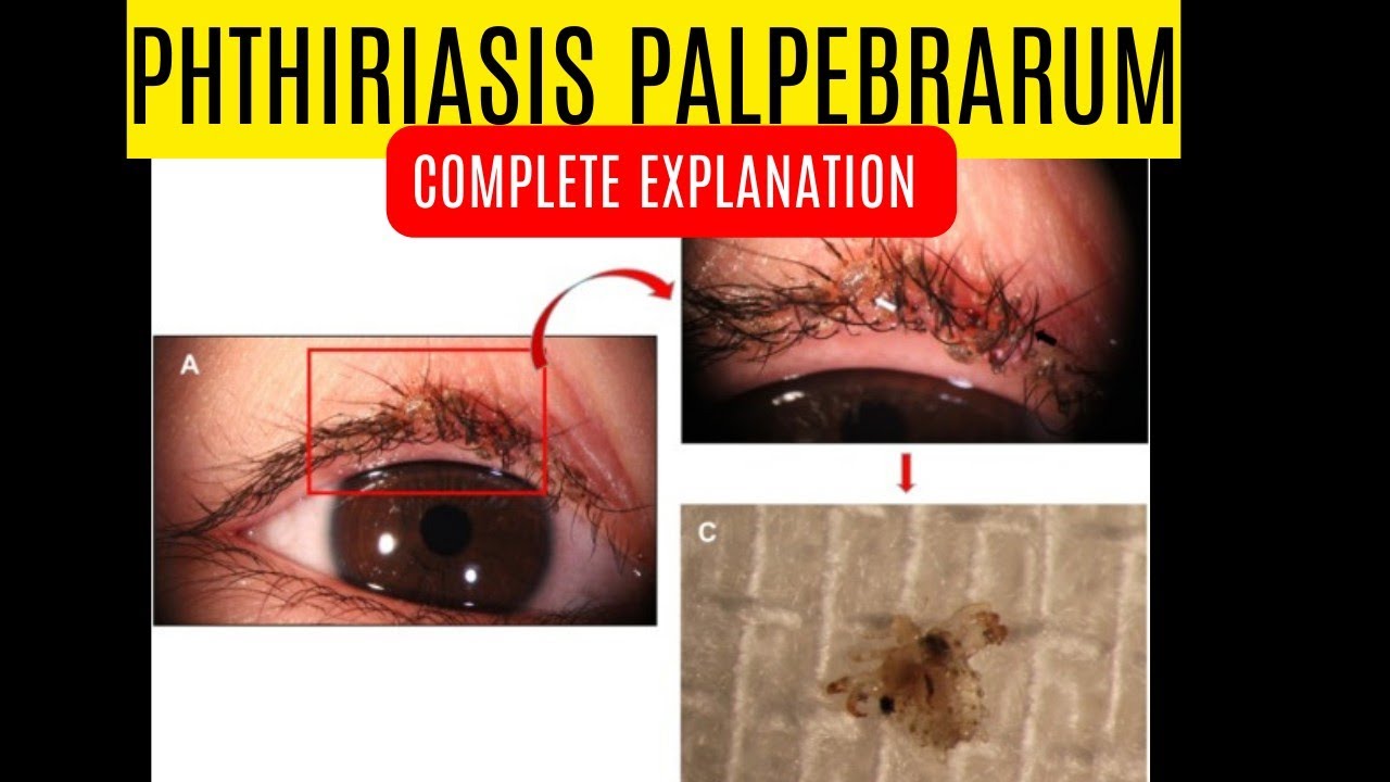 Eyelid Lecture 9 Phthiriasis palpebrarum #eyelid #ophthalmology #eye # ...