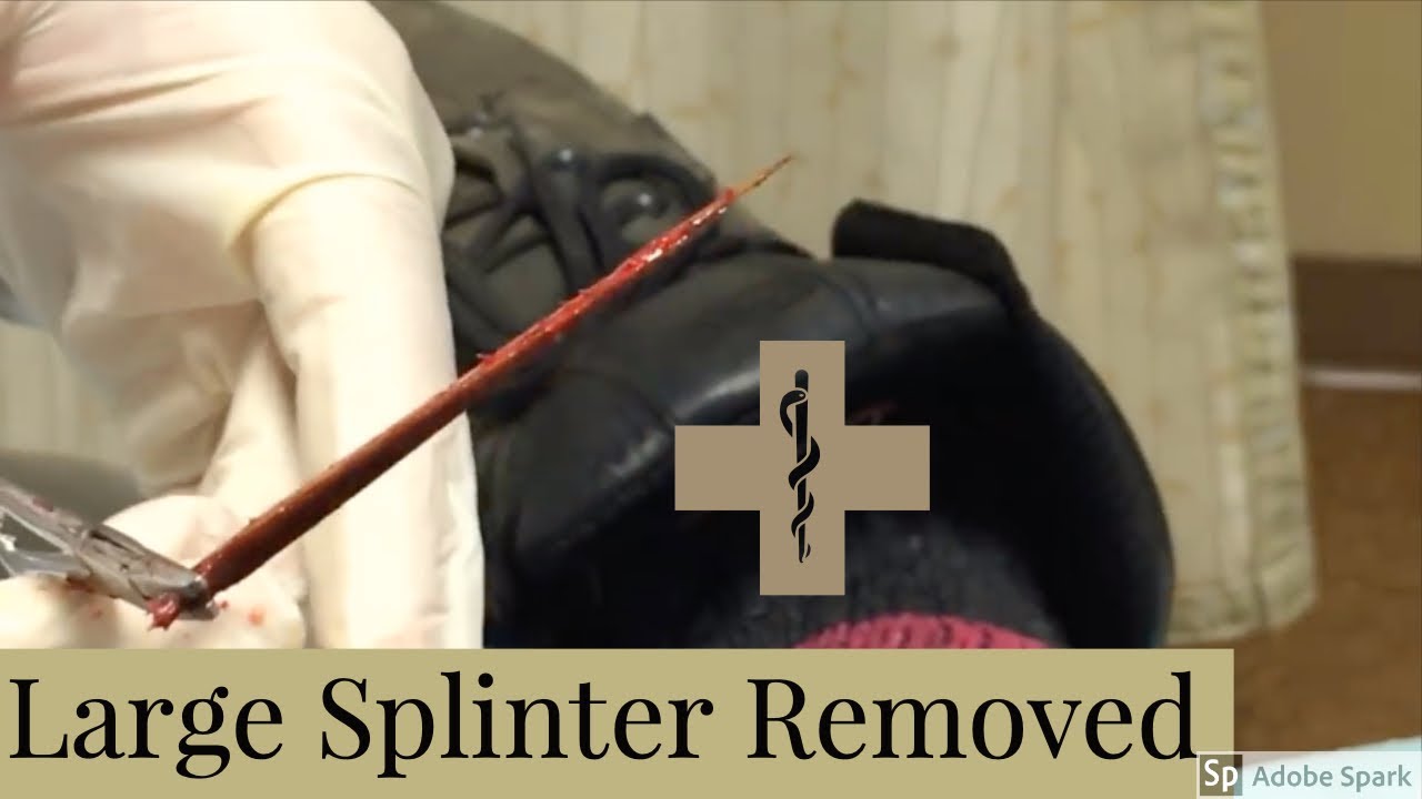 Largest splinter in the leg! - YouTube