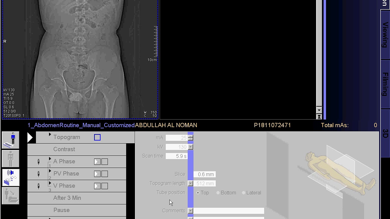 CT scan of urogram techniq - YouTube