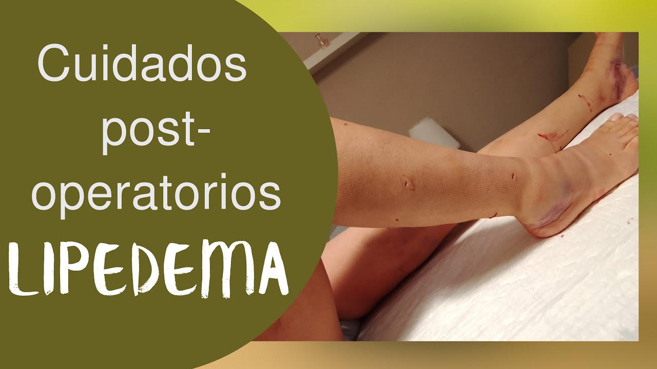 CUIDADOS POST OPERATORIOS LIPEDEMA - YouTube